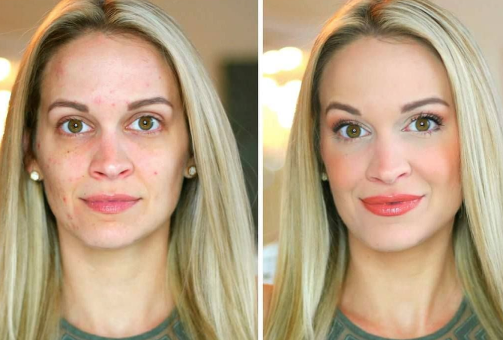 IPL - Avalon Medical Spa